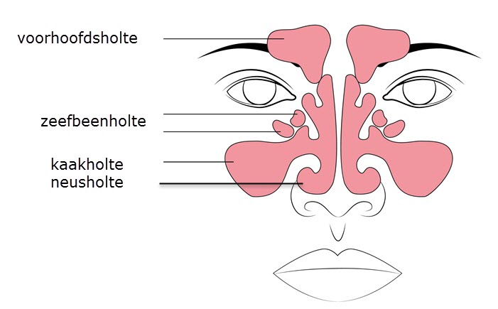 Sinusitis; ontsteking van de neusbijholten - Slingeland Ziekenhuis
